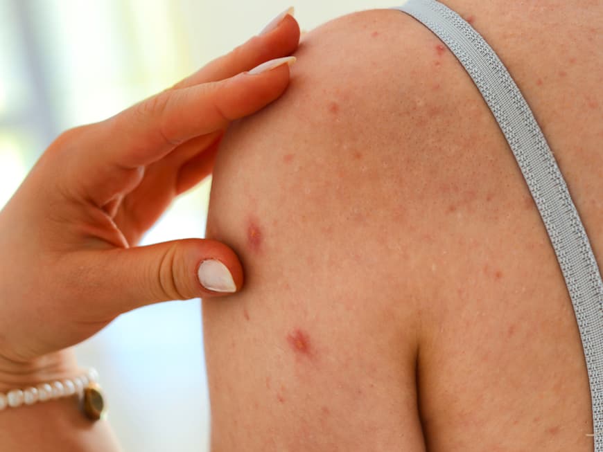 Pickel am Oberarm: Das kannst du dagegen tun!