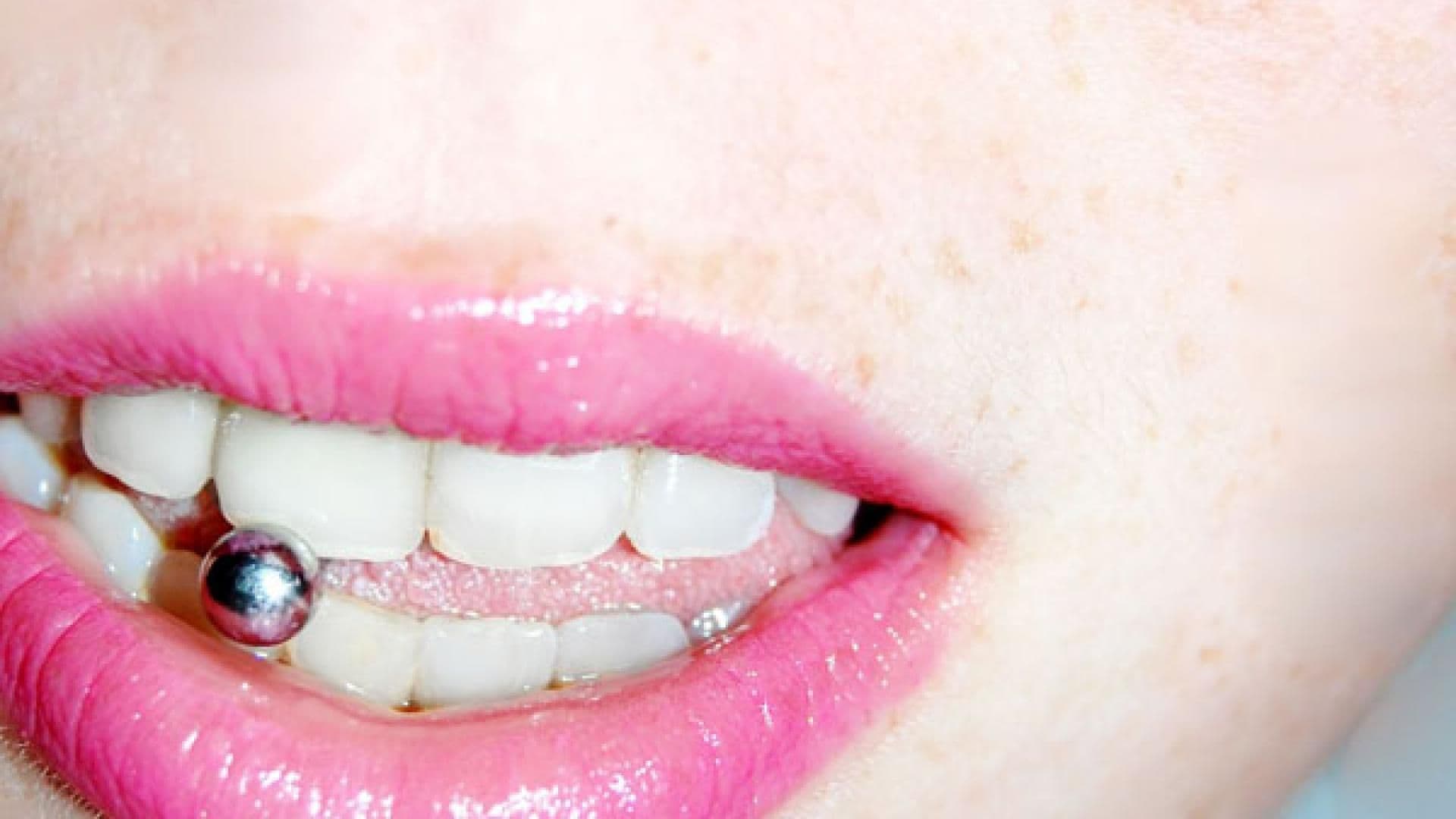 Zungenpiercing beim Zahnarzt